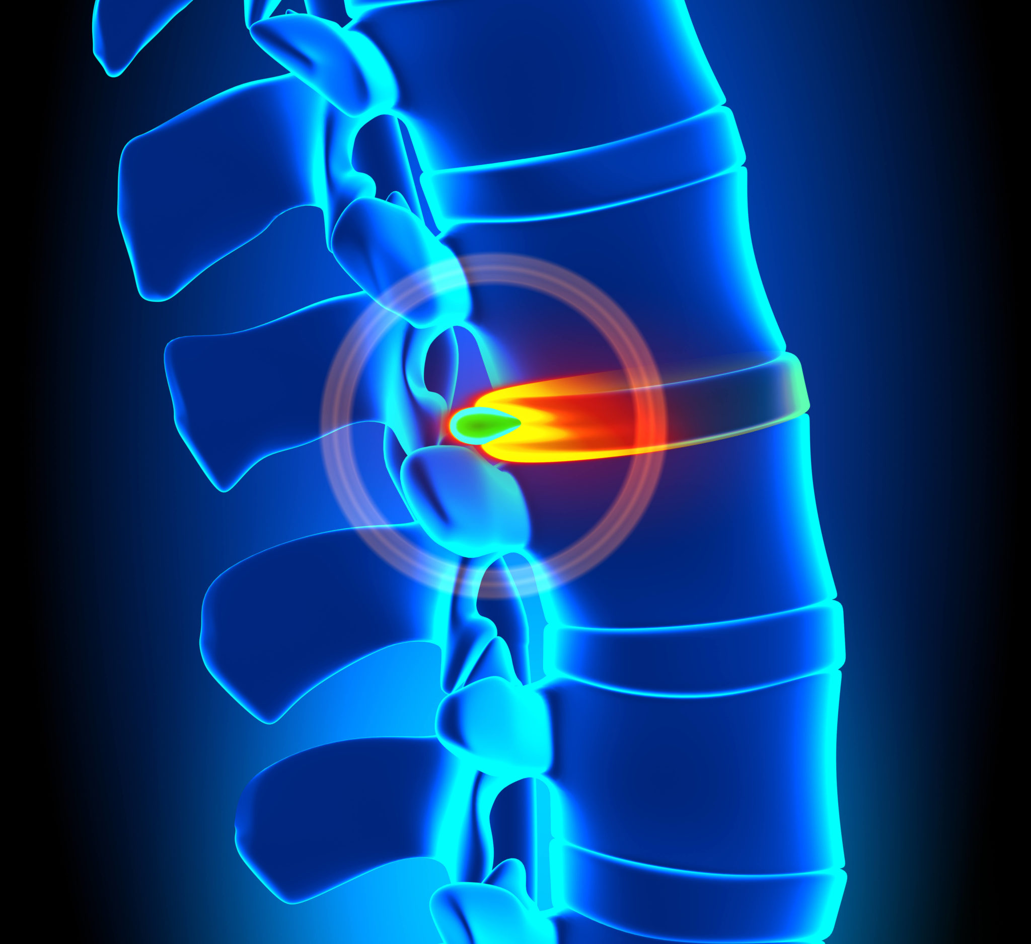 Neurosurgeon for Herniated Disc - Neurosurgery & Spine Consultants