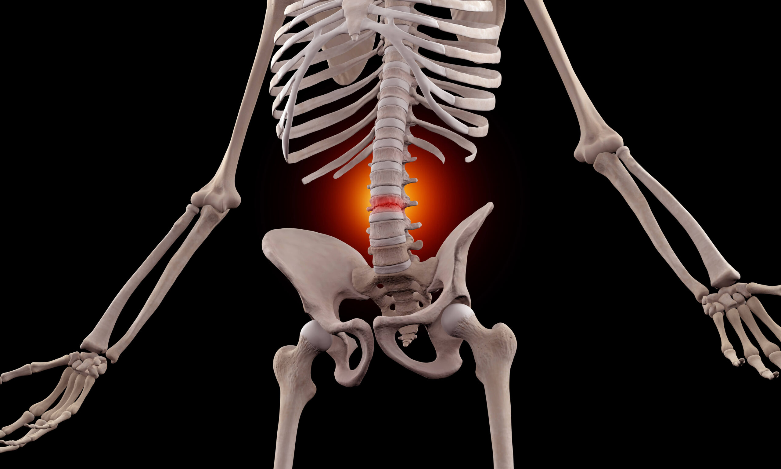 What is a Lumbar Fusion? | NSC