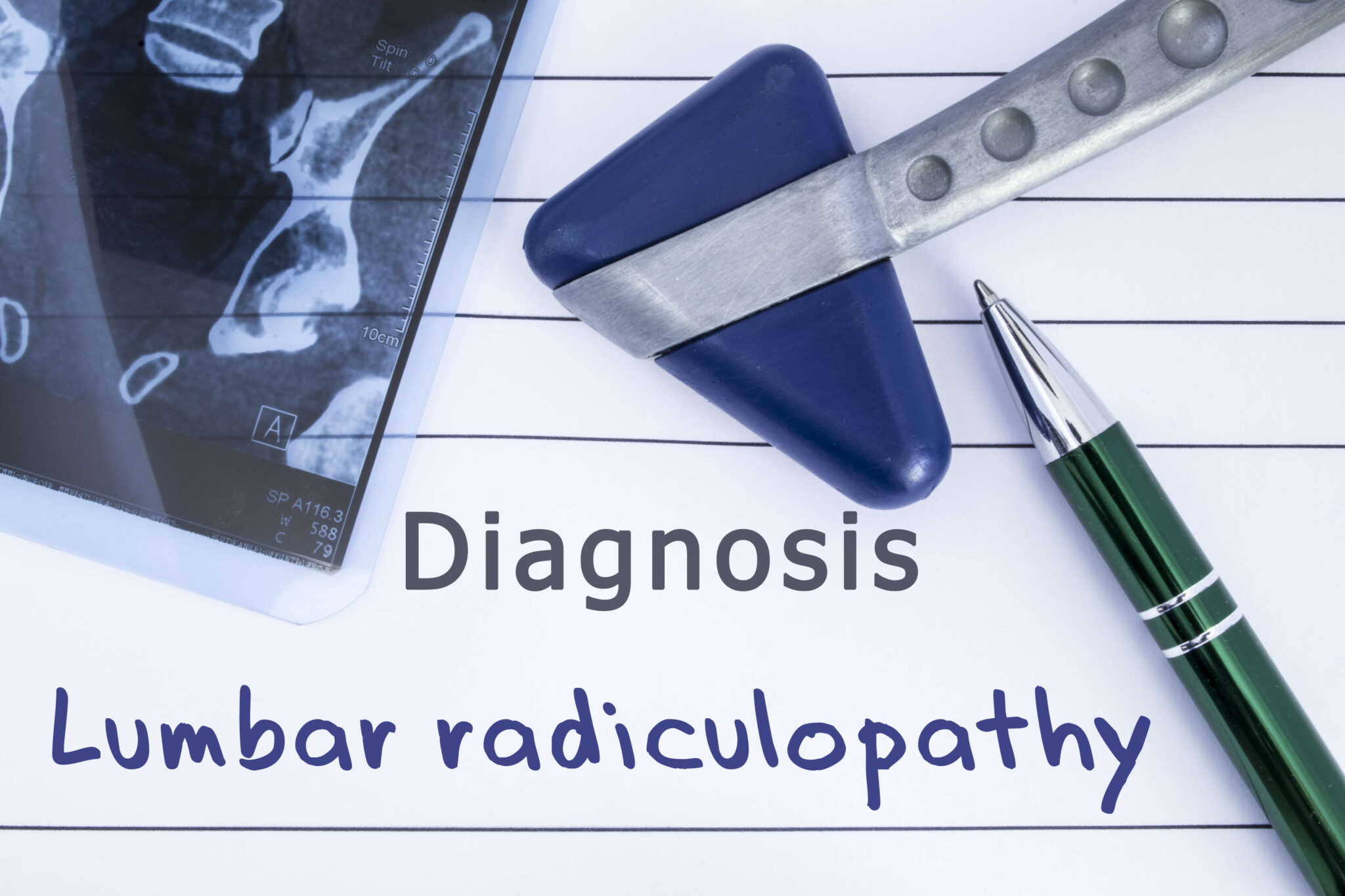 Treatment Options for Lumbar Radiculopathy | NSC