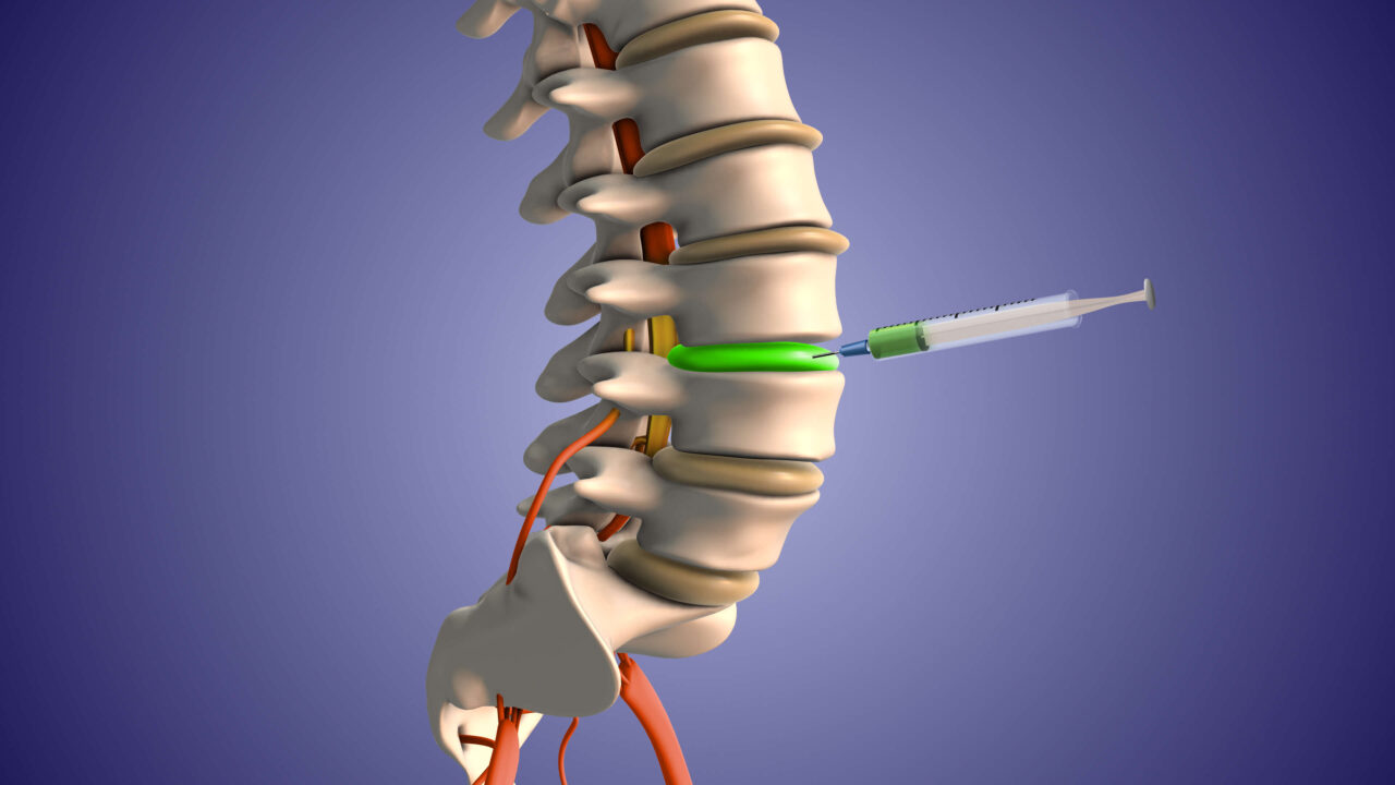 Steroids & Chronic Back Pain: What You Need to Know - Neurosurgery ...