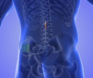 Spinal Cord Stimulation San Antonio - Neurosurgery & Spine Consultants